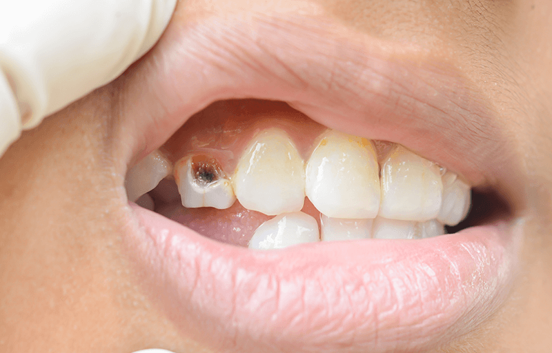 What To Do If You Have A Loose Or Displaced Tooth | Cigna Dental Plans